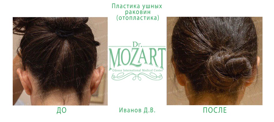 Ear surgery - photo before and after operations in Odessa and Ukraine
